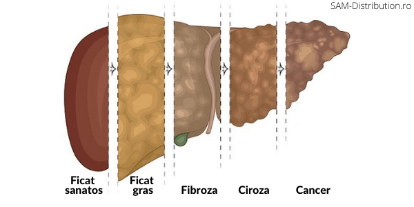 Ficatul gras - simptome ale unui ficat bolnav. Cauze si tratament